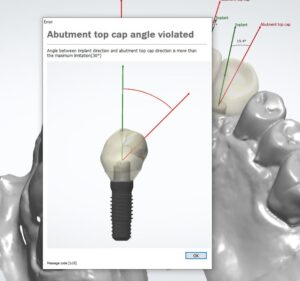 How To Fix “Abutment Top Cap Angle Violated” Error in 3shape ...